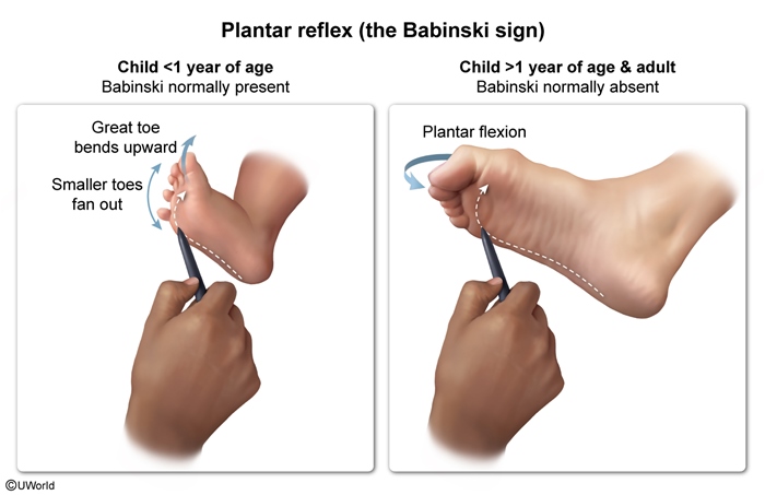 정상 신생아: 발바닥에 주름 많음. 잇몸(gum)에 엡스테인 pearls 있음 : 네이버 블로그